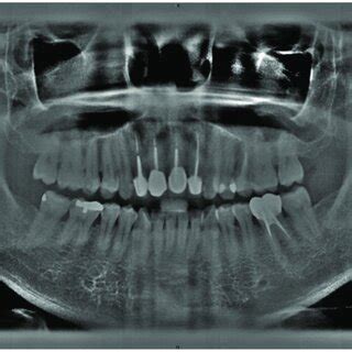 FDI World Dental Federation Notation System Download Scientific Diagram
