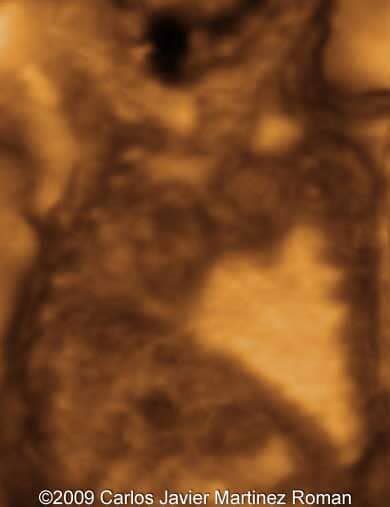 📃 Lung Sequestration Extralobar Intrathoracic
