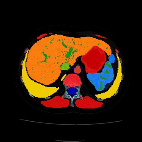 segmentation noise · issue 230 · wasserth totalsegmentator · github