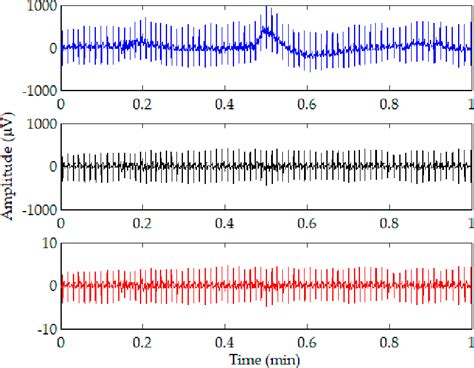 Figure 1 From A Sleep Apnea Detection System Based On A One Dimensional