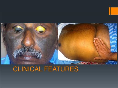 Ppt Obstructive Jaundice Powerpoint Presentation Free Download Id 1867439