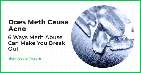 Beware Of This Acne Trigger Does Meth Cause Acne