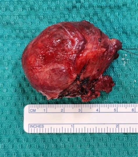 Thyroid Mass Rmedicalgore