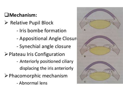 Primary Angle Closure Glaucoma Saral
