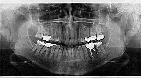 Abnormal Panoramic Dental X Ray