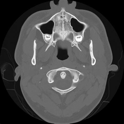 Normal Temporal Bone Ct With Annotated Images Radiopaedia 84293 99584 Axial Non Contrast Nc
