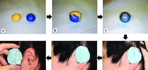 A Brief Procedure Of The Application Of A Silicon Cast For The Download Scientific Diagram