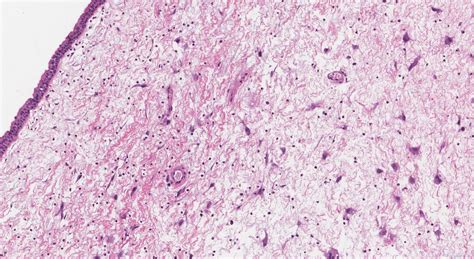 Sinonasal Inflammatory Polyp Ottawa Atlas Of Pathology Sinonasal Inflammatory Polyp Ottawa Atlas Of Pathology