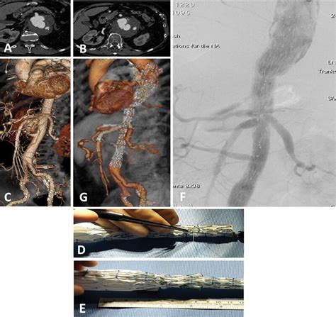 Patient With A Prior Open Thoracoabdominal Aortic Repair Who Developed Download Scientific