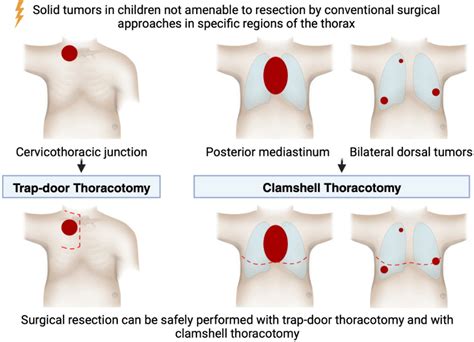 Clamshell Thoracotomy Icd 10 At Joan Byrd Blog