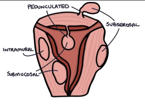 W2 Menstural Dysfunction Flashcards Quizlet