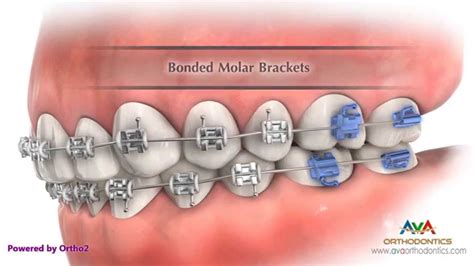 Braces Wire Size Chart Ponasa