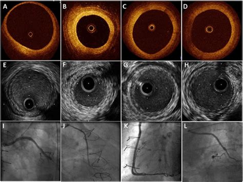 Neointima In Example Svg Shown Angiographically And With Oct And Ivus