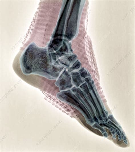 Sprained Ankle Ct Scan Stock Image C026 9962 Science Photo Library