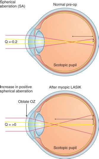 Lasik Q Based And Wavefront Guided Lasik For Myopia Hyperopia And