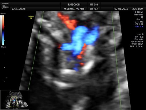 Fetal Pericardial Effusion Looking Through A Transducer