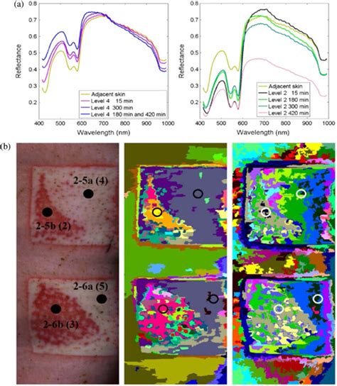 Classification Of Burn Severity Using Hyperspectral Imaging Data A Download Scientific
