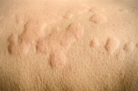 Current Treatment Strategies For Urticaria Dermatology Advisor
