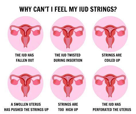 Premium Vector Causes Not Feel Iud Strings Intrauterine Device In Vector