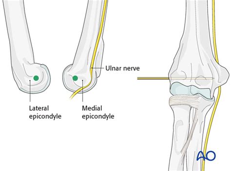 Hinged External Fixation Following Orif For Anterior Transolecranon Fracture Dislocation