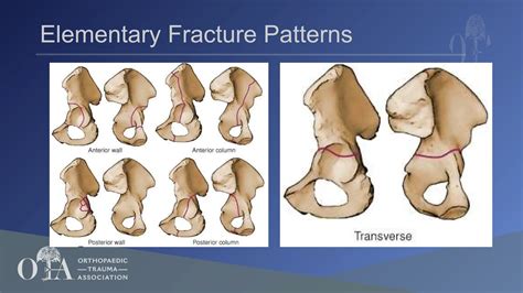 6radiographic Understanding Evaluation And Classification Of Acetabular