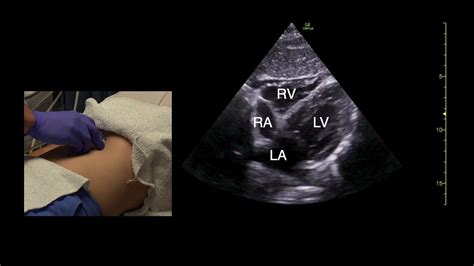 Cardiopulmonary Pocus 5 The Subcostal Cardiac View Youtube