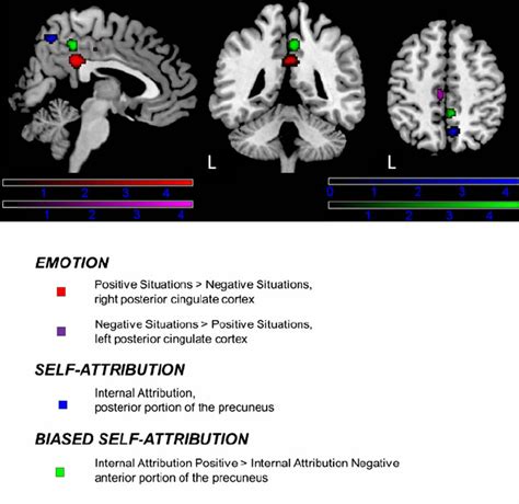 Schematic Depiction Of The Precuneus And The Posterior Cingulate Cortex