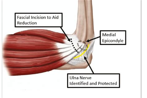 36 Facts About Epicondyle