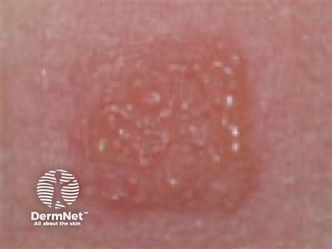 Baseline Series Of Patch Test Allergens