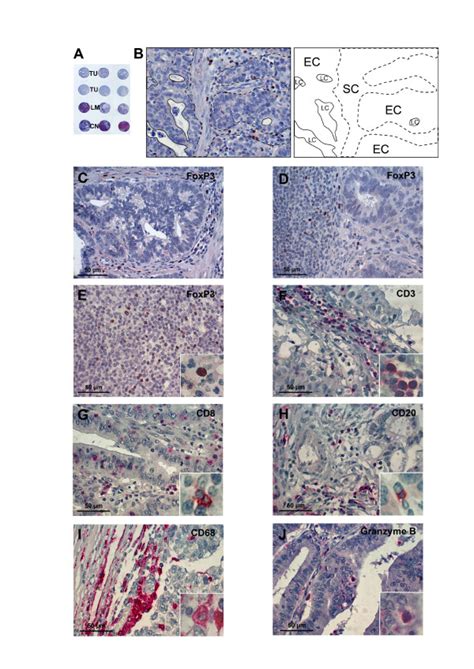 tissue microarrays a tissue microarray tumor punches [tu