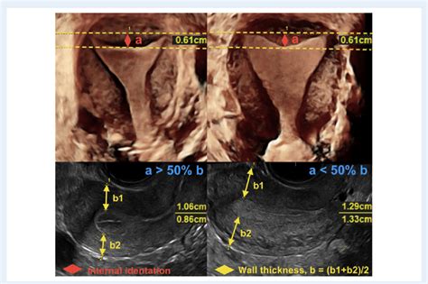 Normal Uterus By Asrm With The Same Length Of Internal Fundal