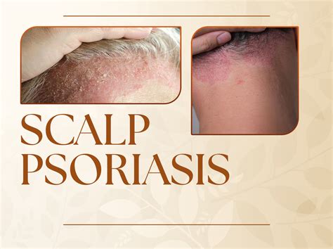 How Does Scalp Psoriasis Impact Your Body
