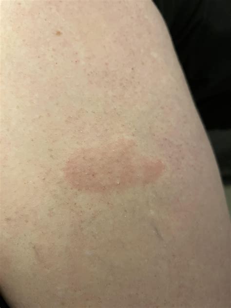 Rash At Injection Site On 10mg R Mounjaro