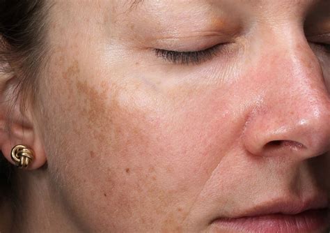 Melasma Mona Dermatology