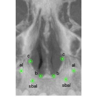 PDF Forensic Facial Reconstruction Relationship Between The Alar