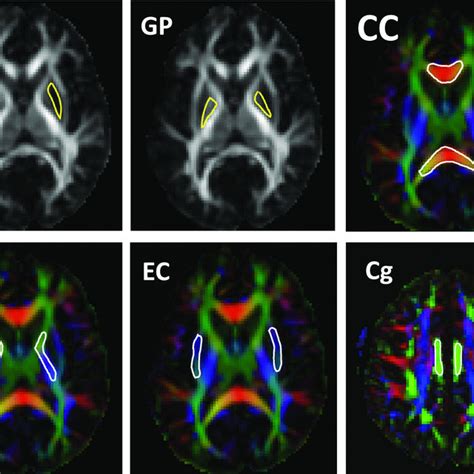 Representative 3 Axial Slices Of Mean Kurtosis Mk Axial Kurtosis