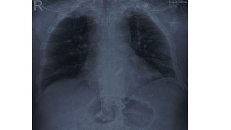Micra Leadless Pacemaker Insertion Technique Pptx