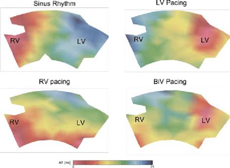 Examples Of Post LBBB Recorded AT Maps During Sinus Rhythm And During Download Scientific