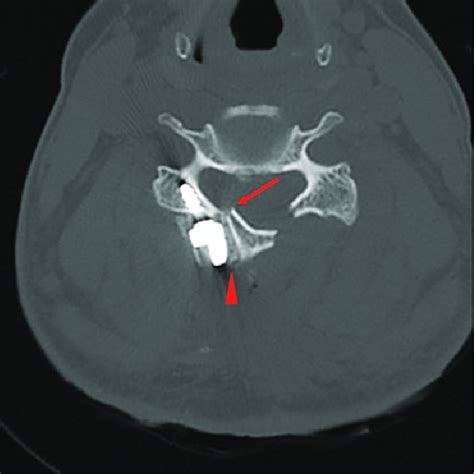 A Case Of Complete Hinge Fracture The Arrow Indicates Comp Lete Hinge Download Scientific