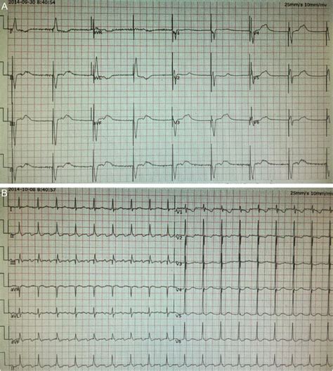 Ecg After Pacemaker Implantation A The Left Bundle Branch Block In Ecg Download Scientific