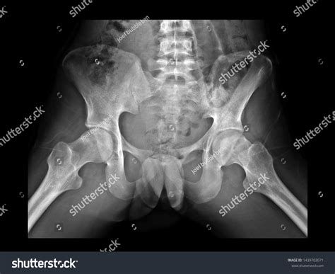 Film Xray Hip Radiograph Show Femoroacetabular库存照片1439703071 Shutterstock