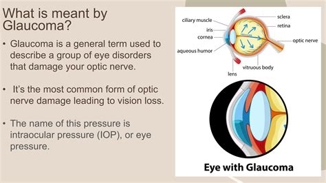 Glaucoma Screening Test By Segmentation Of Optical Disc And Cup Using Matlab Ppt