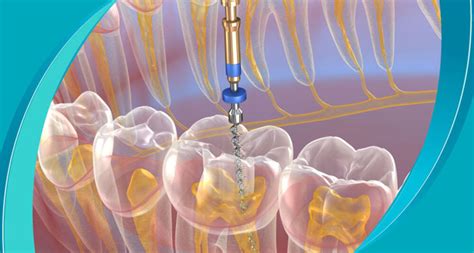 Endodontics Üsküdar Dental Hospital
