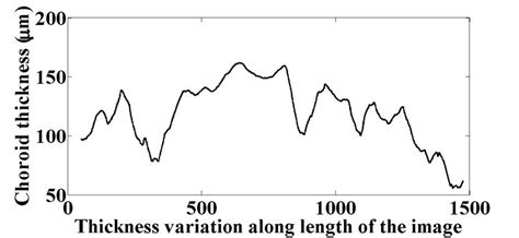 Denoising Localization Of Choroid Choroid Boundary And Vessel