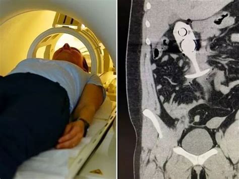 Sex Toy Dragged Through Woman S Body In Horrific MRI Scan News ISC
