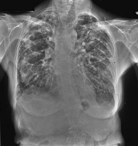 Diffuse Lung Disease Thoracic Key