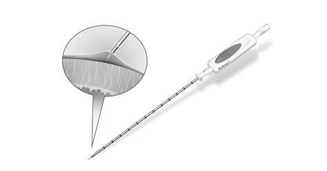 Circa Scientific Announces Fda Clearance Of Pericross™ Epicardial Access Kit