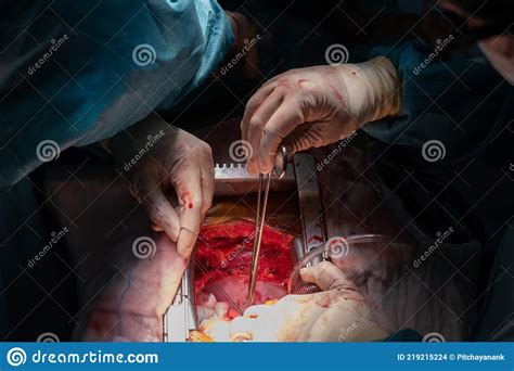Coronary Artery Bypass Graft Operation Cabg Stock Photo Image Of