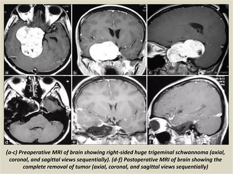 Presentation1 Radiological Imaging Of Trigeminal Schwanoma Pptx