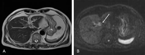 Figure 1 From Hilar Cholangiocarcinoma With Extensive Immunoglobulin G4